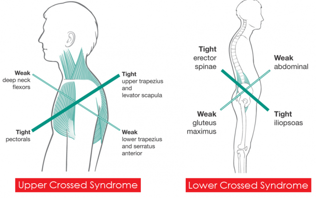 Upper Cross Syndrome And Lower Cross Syndrome